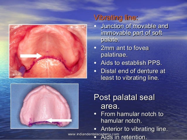 Anatomical landmarks/ dental implant courses by Indian dental academy