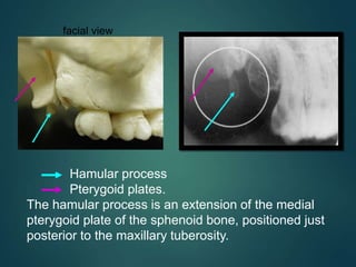 Hamular Process