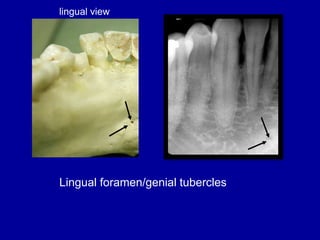 Lingual Foramen