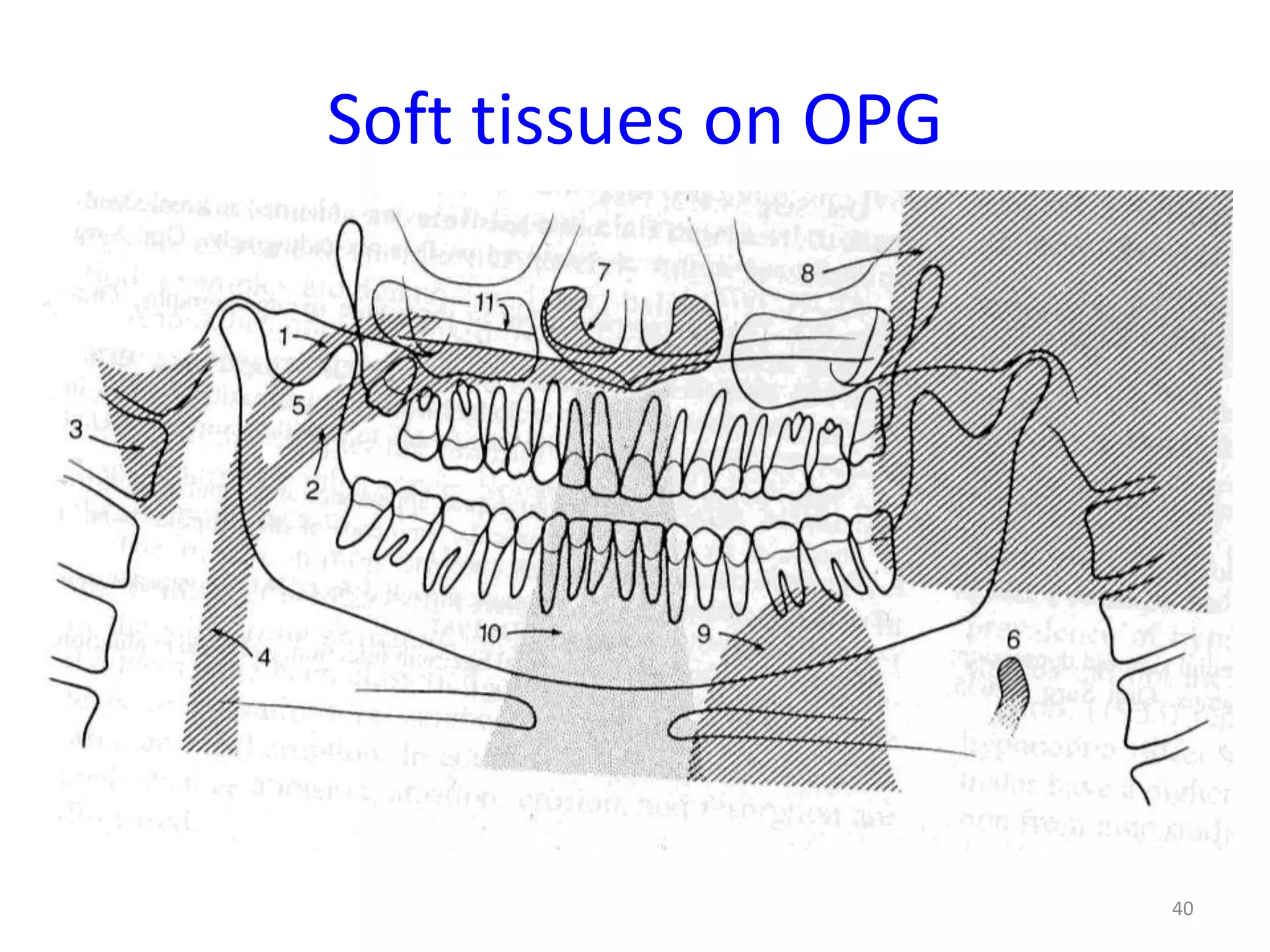 Anatomical landmarks in Periapical and Orthopantomogram X-ray | PPTX