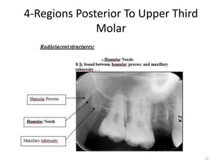 Periapical X Ray