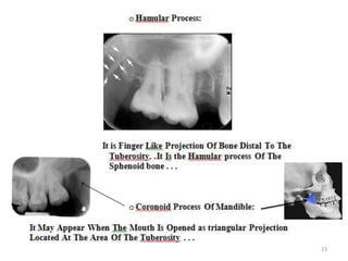 Hamular Notch Radiograph
