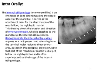 External Oblique Ridge Cbct