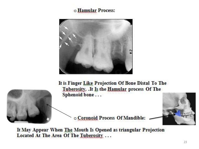 Hamular Notch Radiograph