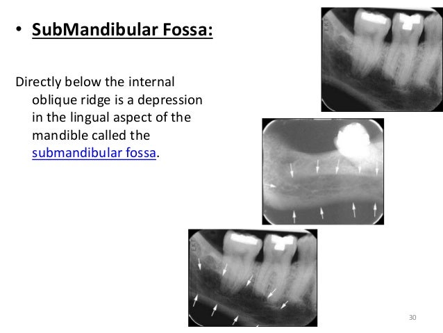 Submandibular Fossa