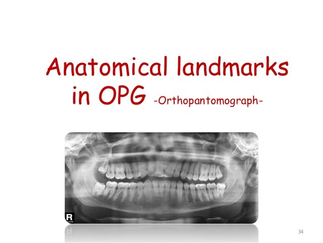 Anatomical landmarks in Periapical and Orthopantomogram X-ray