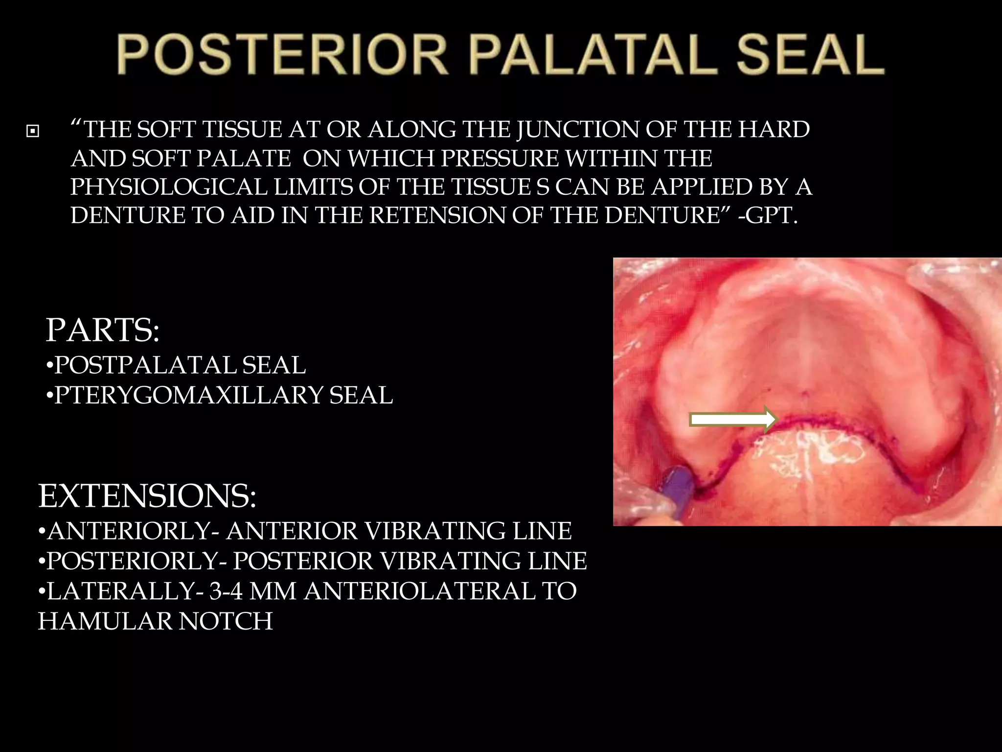Anatomical landmarks of denture bearing area of.pptx final | PPTX