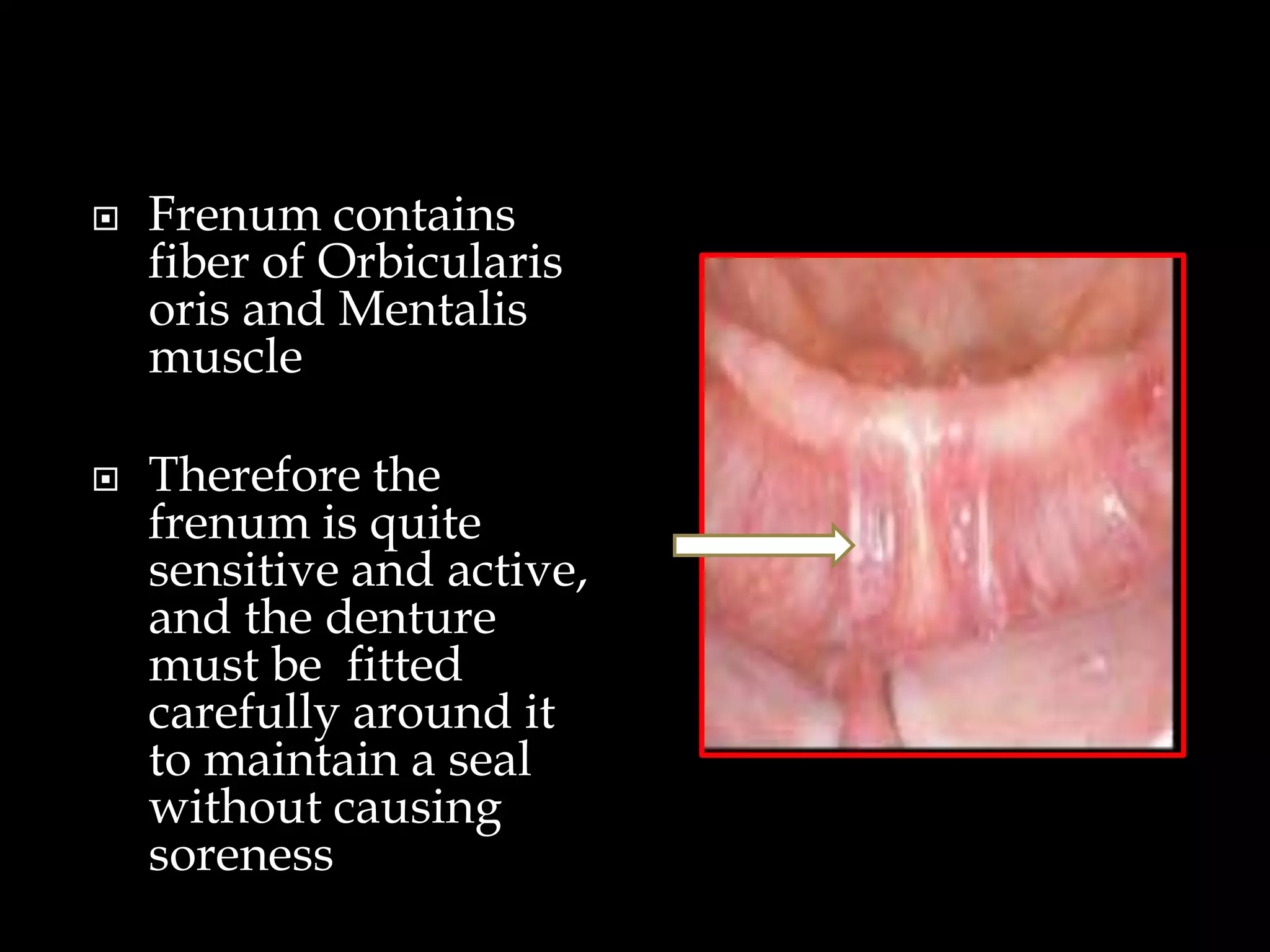 Anatomical landmarks of denture bearing area of.pptx final | PPTX
