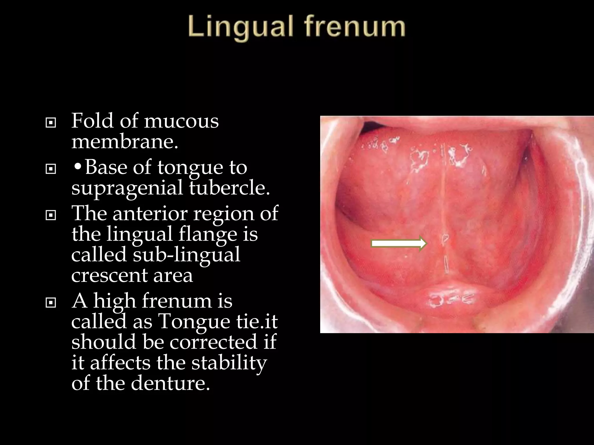 Anatomical landmarks of denture bearing area of.pptx final | PPTX