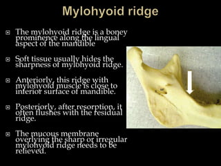 Mylohyoid Ridge Denture