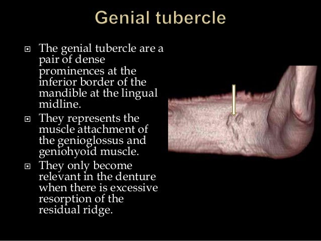 Genial Tubercle Osteology Of The Facial Skeleton And Naso Ethmoidal