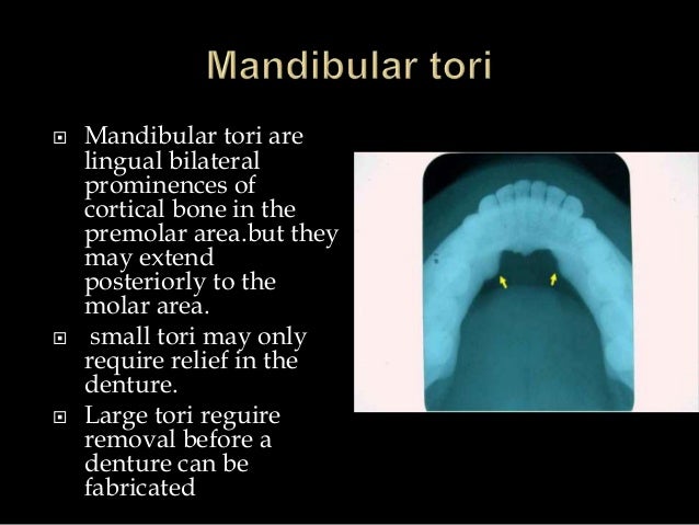 Tori Mouth Bone Under Tongue
