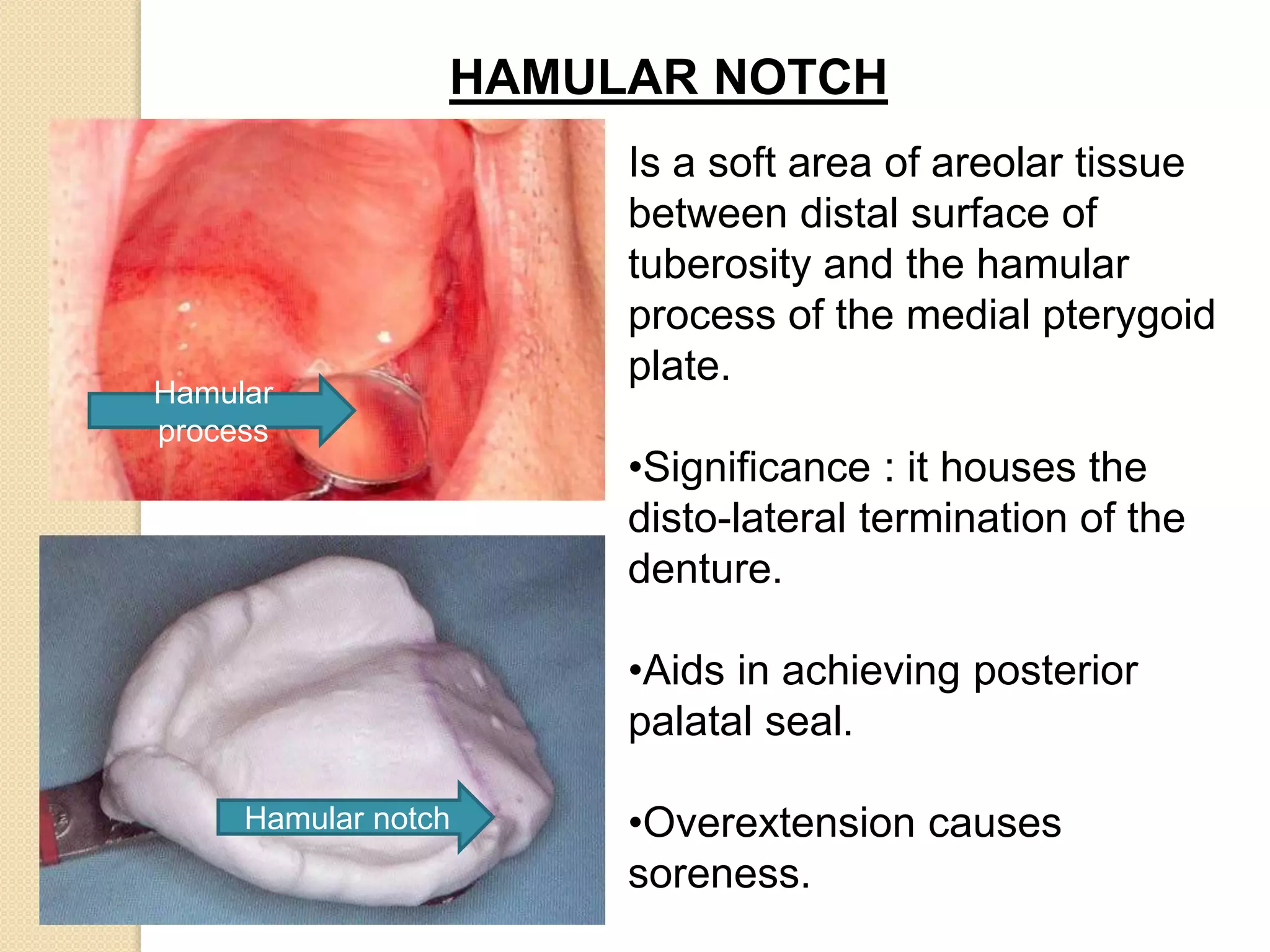 ANATOMICAL LANDMARKS OF EDENTULOUS MOUTH IN COMPLETE DENTURE.pptx