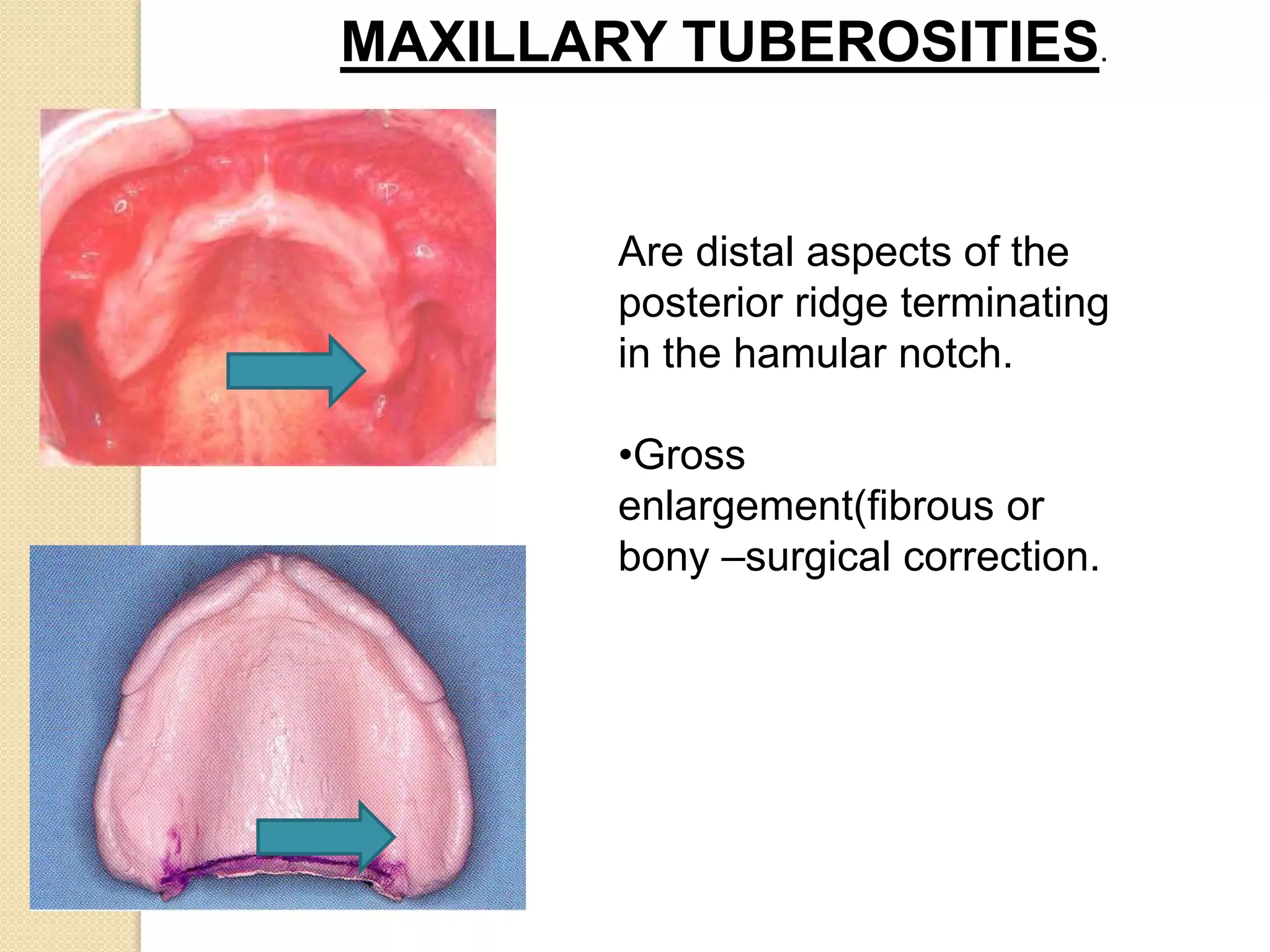 ANATOMICAL LANDMARKS OF EDENTULOUS MOUTH IN COMPLETE DENTURE.pptx