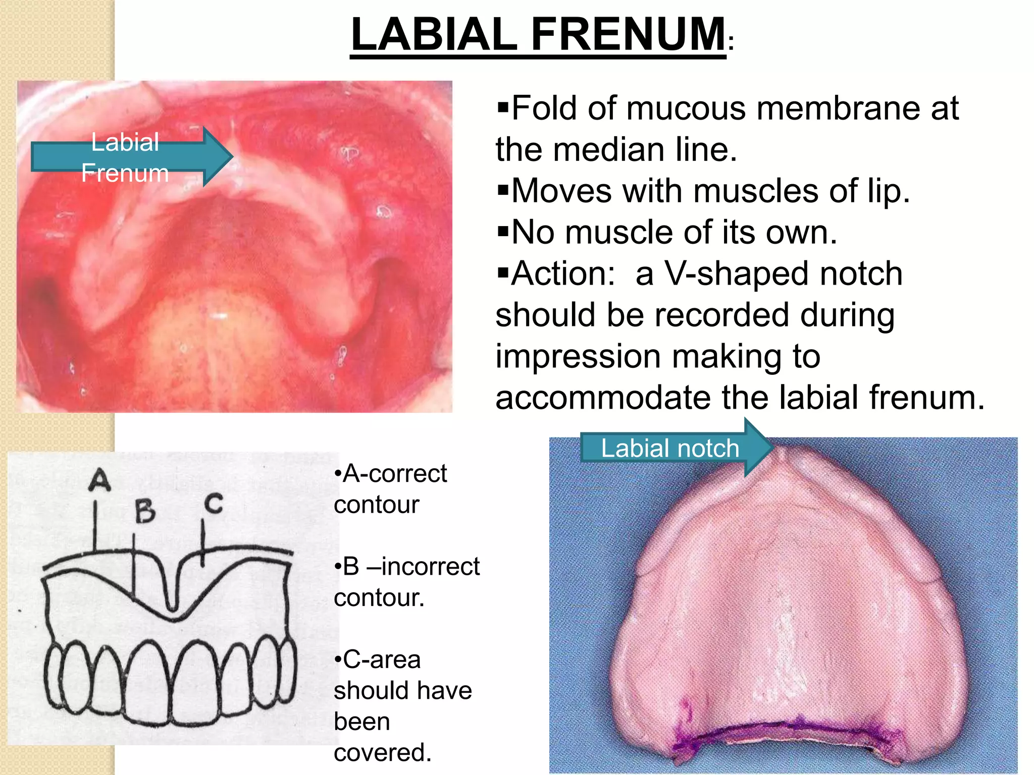 ANATOMICAL LANDMARKS OF EDENTULOUS MOUTH IN COMPLETE DENTURE.pptx