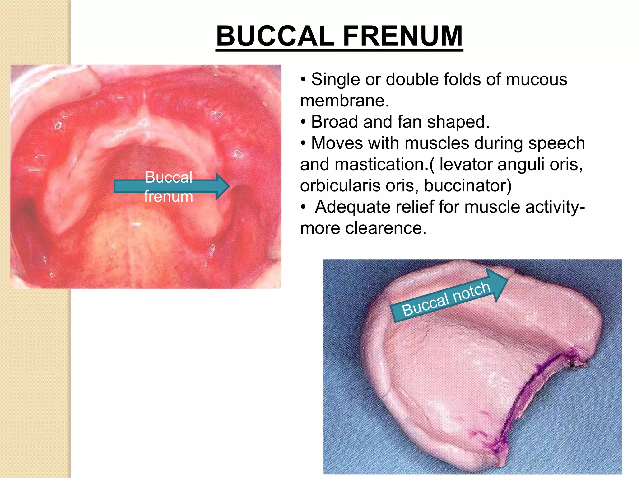ANATOMICAL LANDMARKS OF EDENTULOUS MOUTH IN COMPLETE DENTURE.pptx