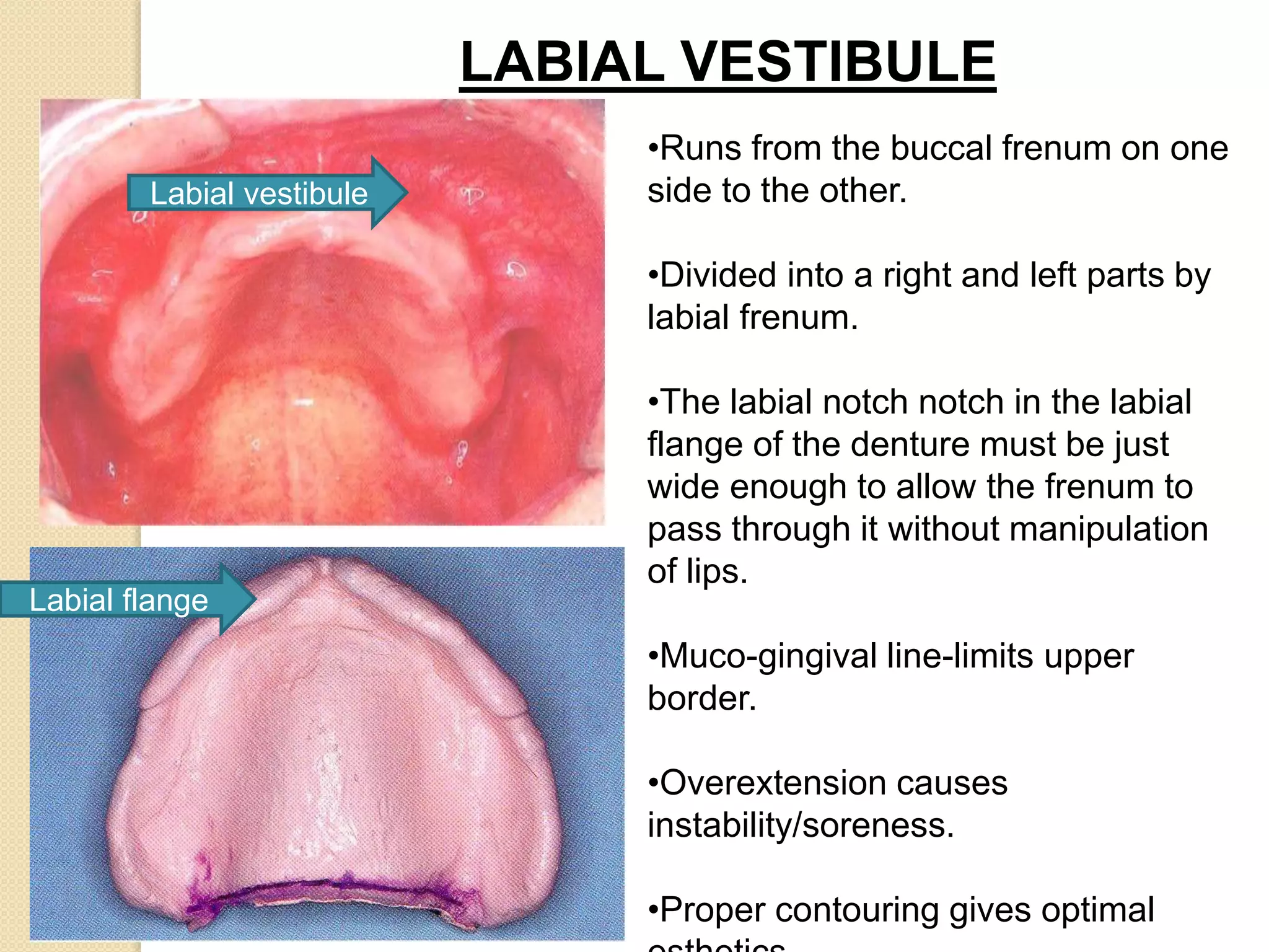 ANATOMICAL LANDMARKS OF EDENTULOUS MOUTH IN COMPLETE DENTURE.pptx