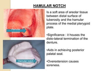 ANATOMICAL LANDMARKS OF EDENTULOUS MOUTH IN COMPLETE DENTURE.pptx