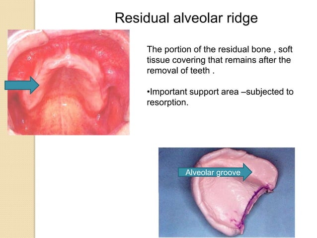 ANATOMICAL LANDMARKS OF EDENTULOUS MOUTH IN COMPLETE DENTURE.pptx | Ear ...