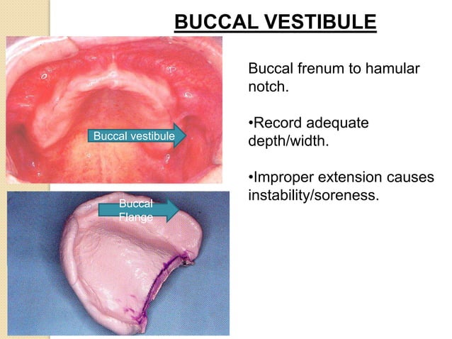 ANATOMICAL LANDMARKS OF EDENTULOUS MOUTH IN COMPLETE DENTURE.pptx | Ear ...