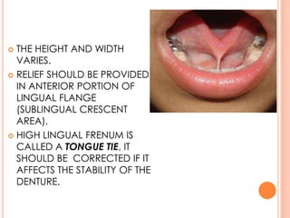 Sublingual Sulcus