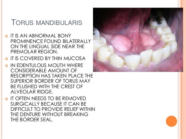 Opinions On Torus Mandibularis