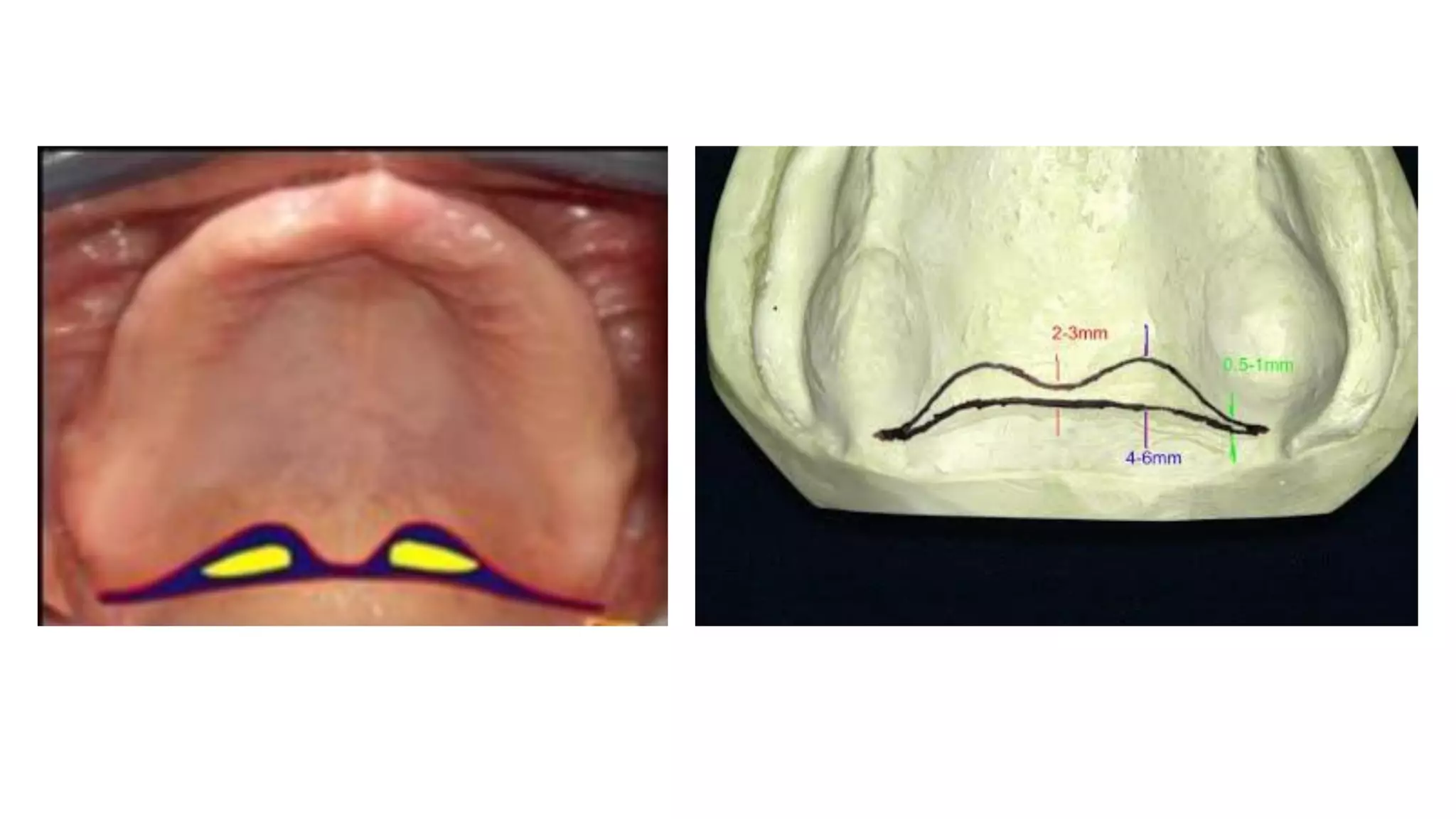 Anatomical landmarks of maxilla | PDF
