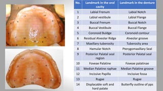 Anatomical landmarks of maxilla | PPTX