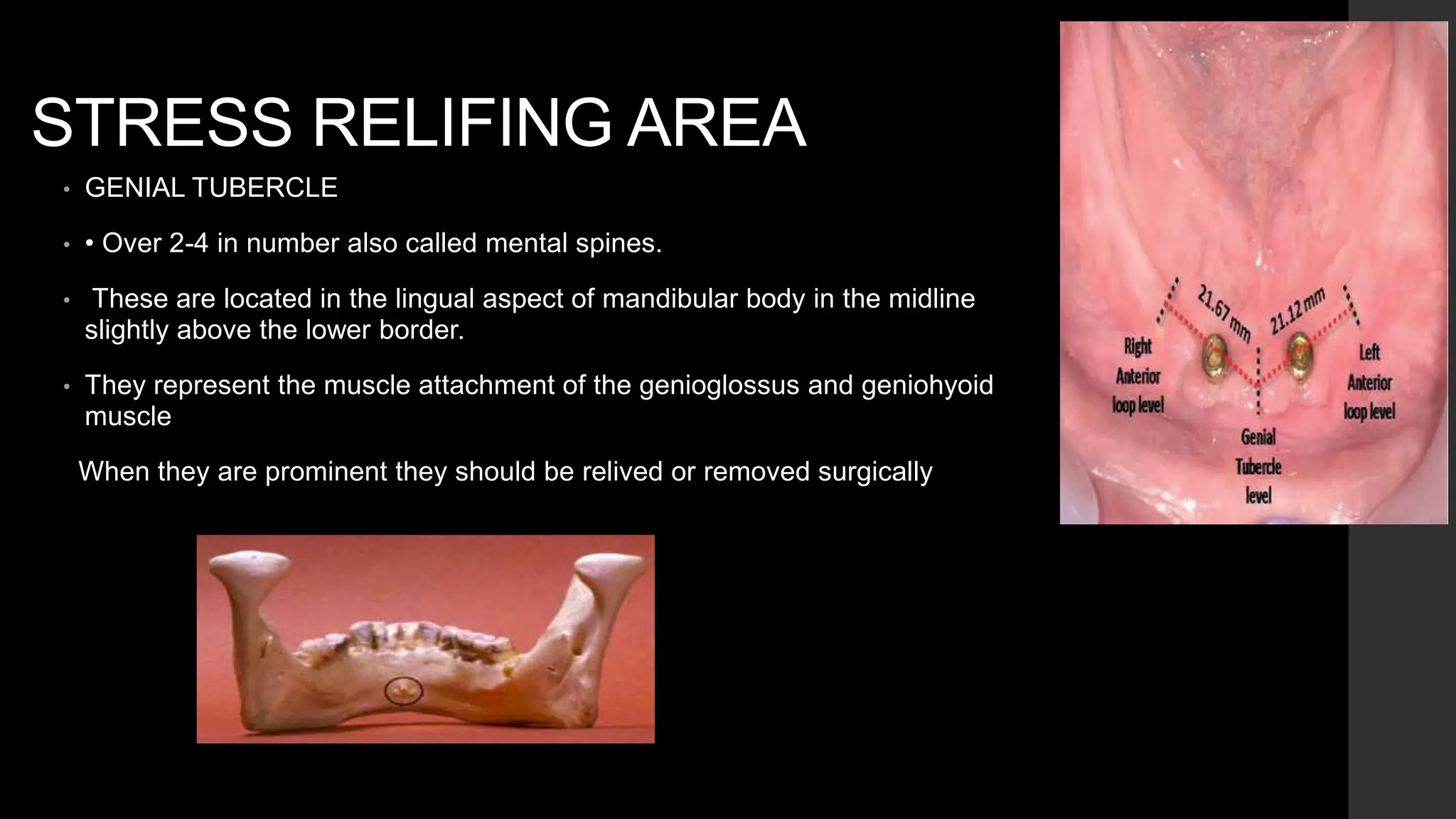 ANATOMICAL LANDMARKS OF MAXILLA AND MANDIBLE.pptx