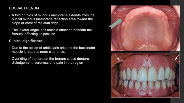 ANATOMICAL LANDMARKS OF MAXILLA AND MANDIBLE.pptx | Dental Health ...