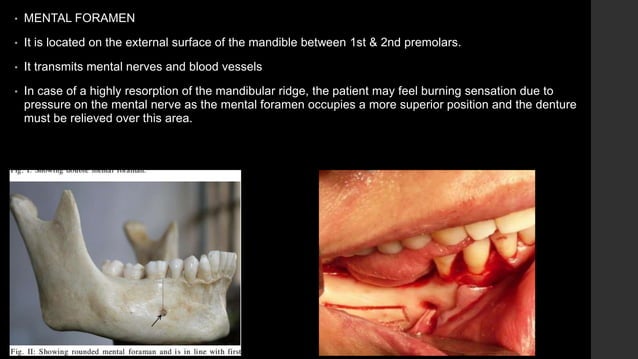 ANATOMICAL LANDMARKS OF MAXILLA AND MANDIBLE.pptx | Dental Health ...