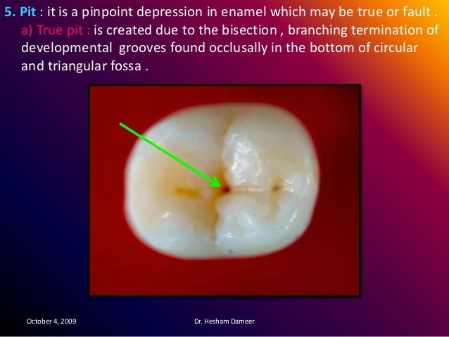 Anatomical landmarks of the crown