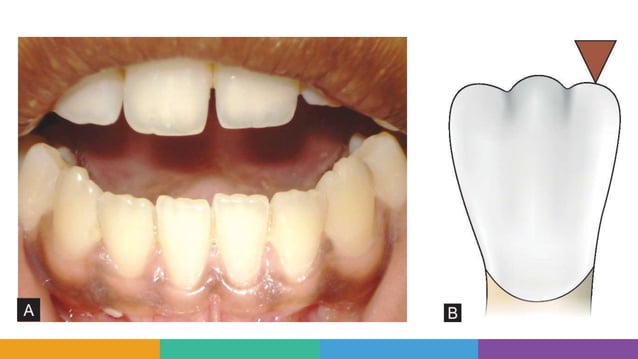 Anatomical Landmarks of tooth.pptx | Dental Health | Diseases and ...