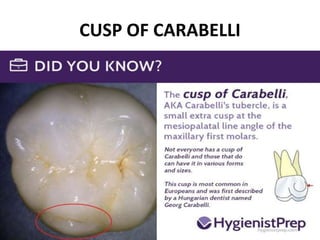 Cusp Of Carabelli