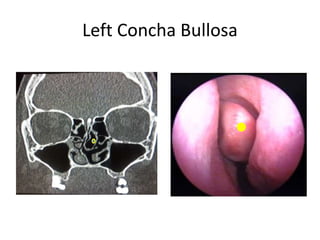 Anatomical variations in nose & pns | PPTX