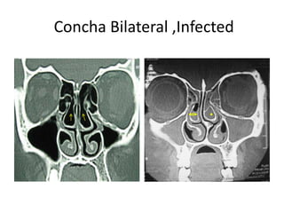 Anatomical variations in nose & pns | PPTX