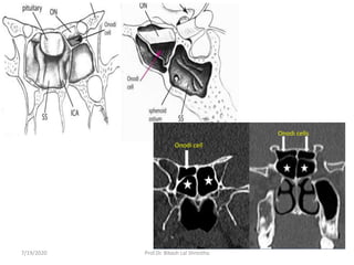 Anatomical variations in sinonasal region (ct scan overview) | PPTX