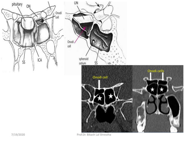 Anatomical variations in sinonasal region (ct scan overview) | PPT