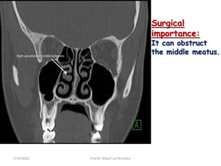 Anatomical variations in sinonasal region (ct scan overview) | PPTX