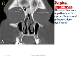 Anatomical variations in sinonasal region (ct scan overview) | PPTX