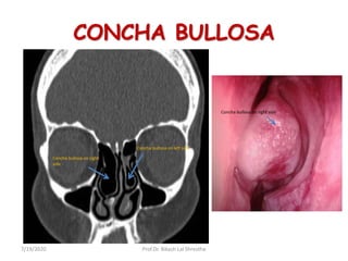 Anatomical variations in sinonasal region (ct scan overview) | PPTX