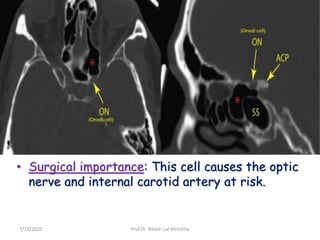 Anatomical variations in sinonasal region (ct scan overview) | PPTX