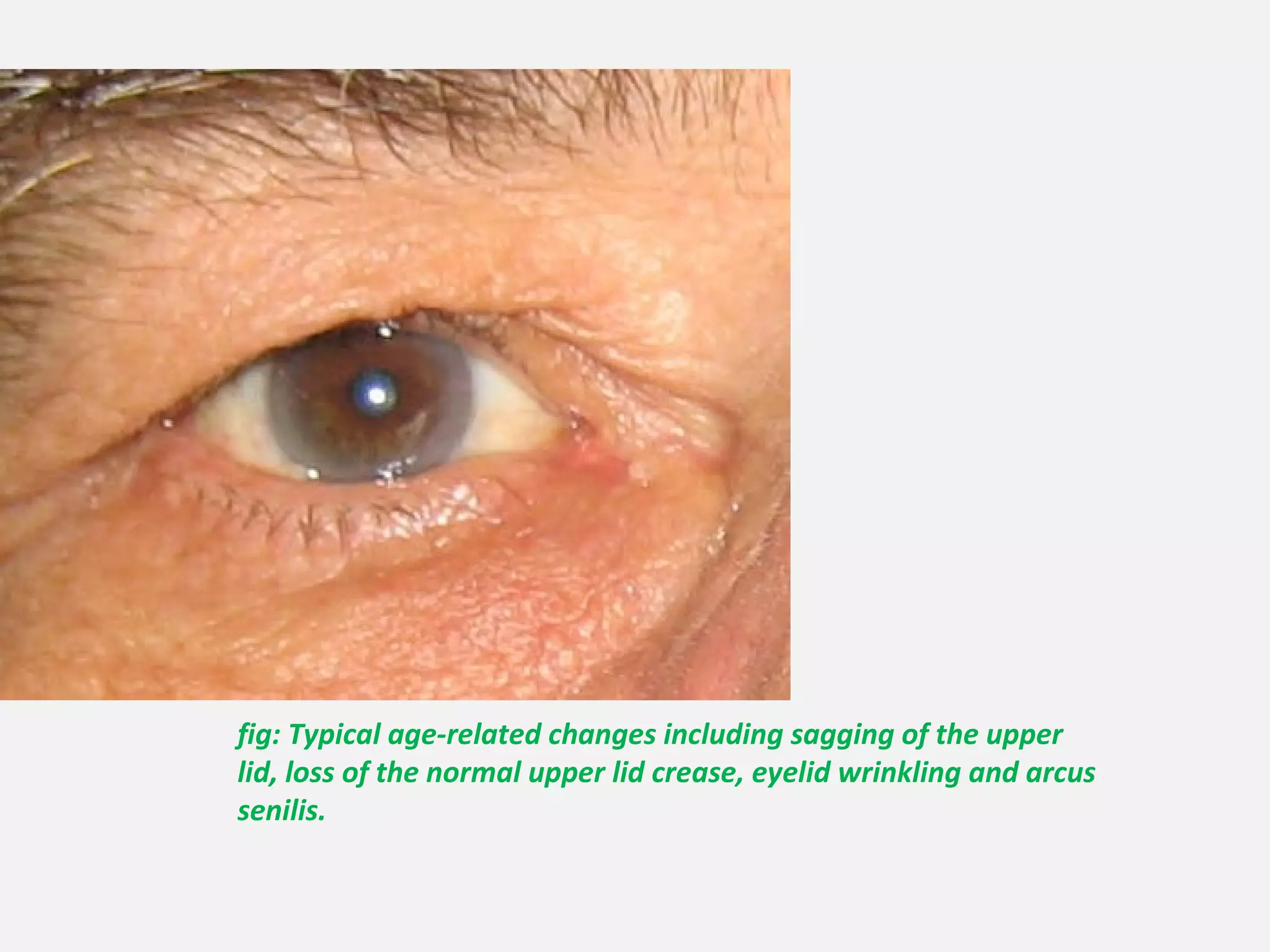 Anatomic and physiological ocular changes with age final | PPT