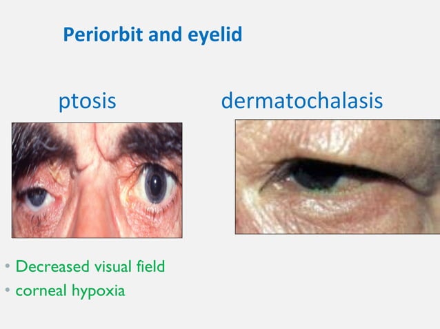 Anatomic and physiological ocular changes with age final | PPT | Eye ...