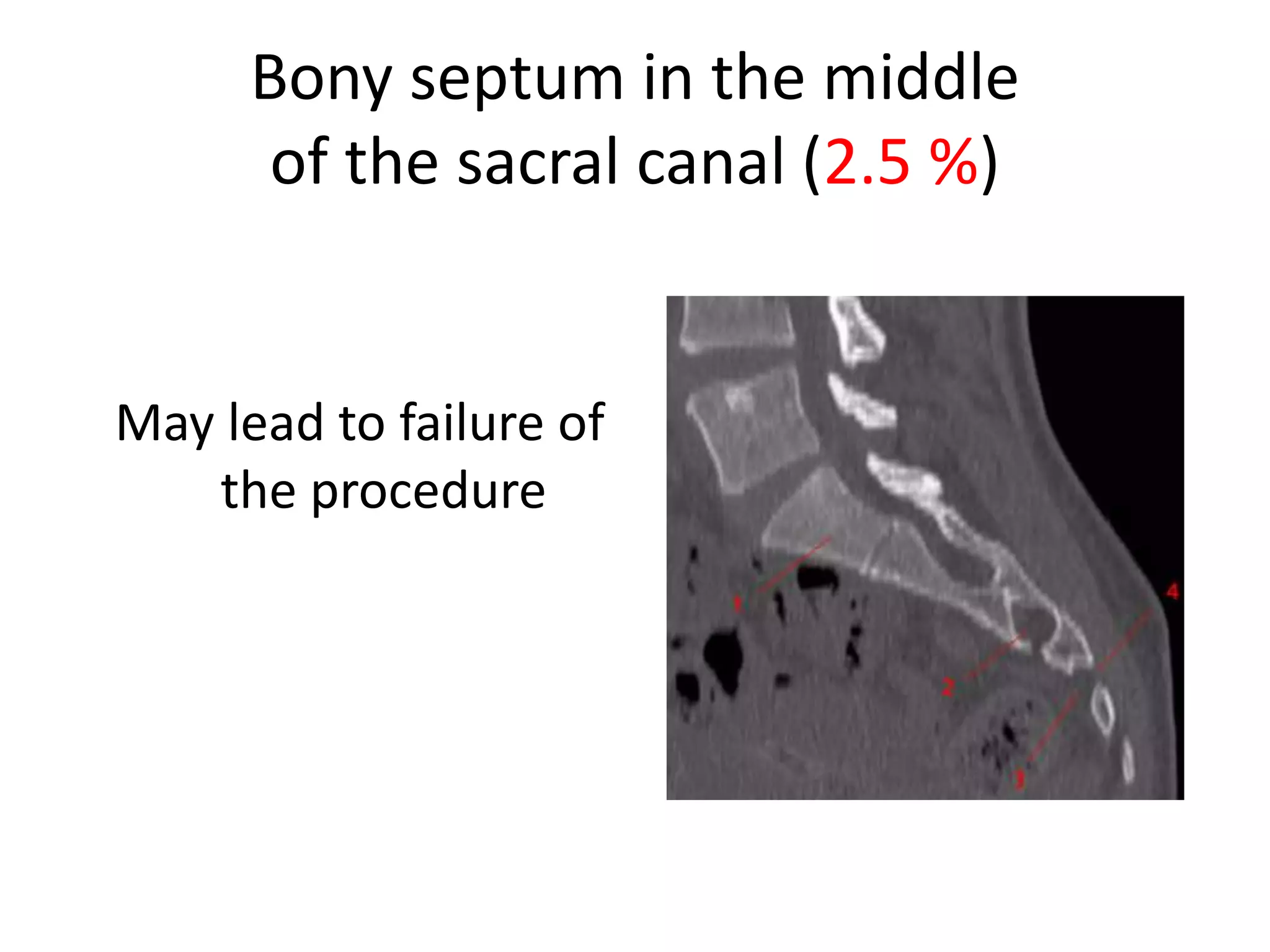 Anatomic basis of epiduroscopy | PPTX
