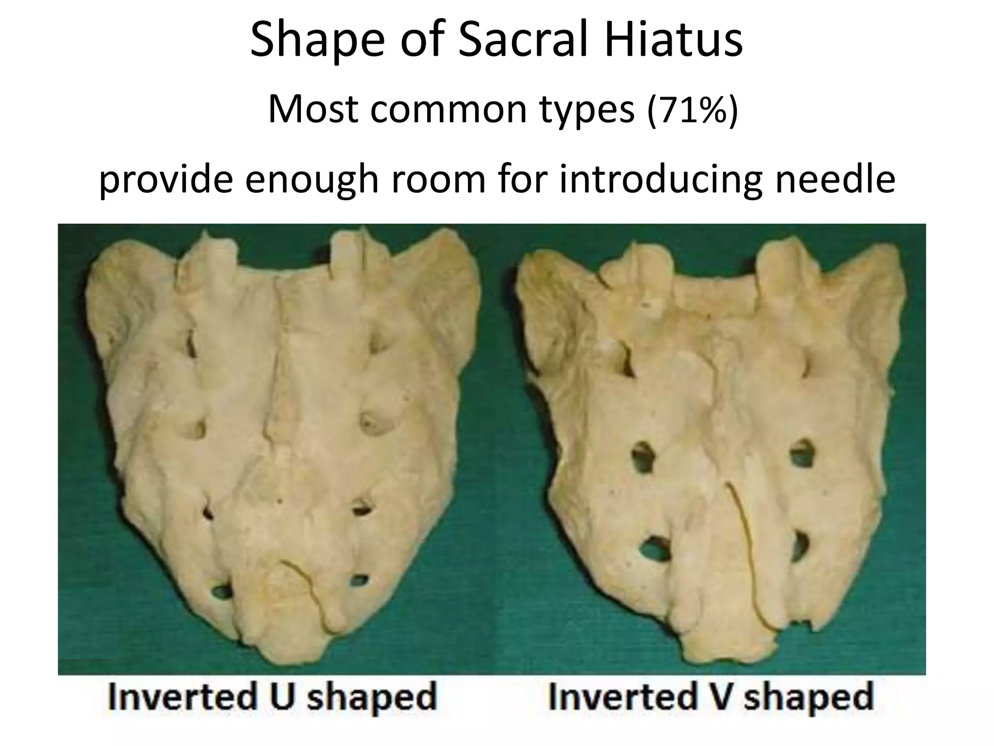 Anatomic basis of epiduroscopy | PPTX