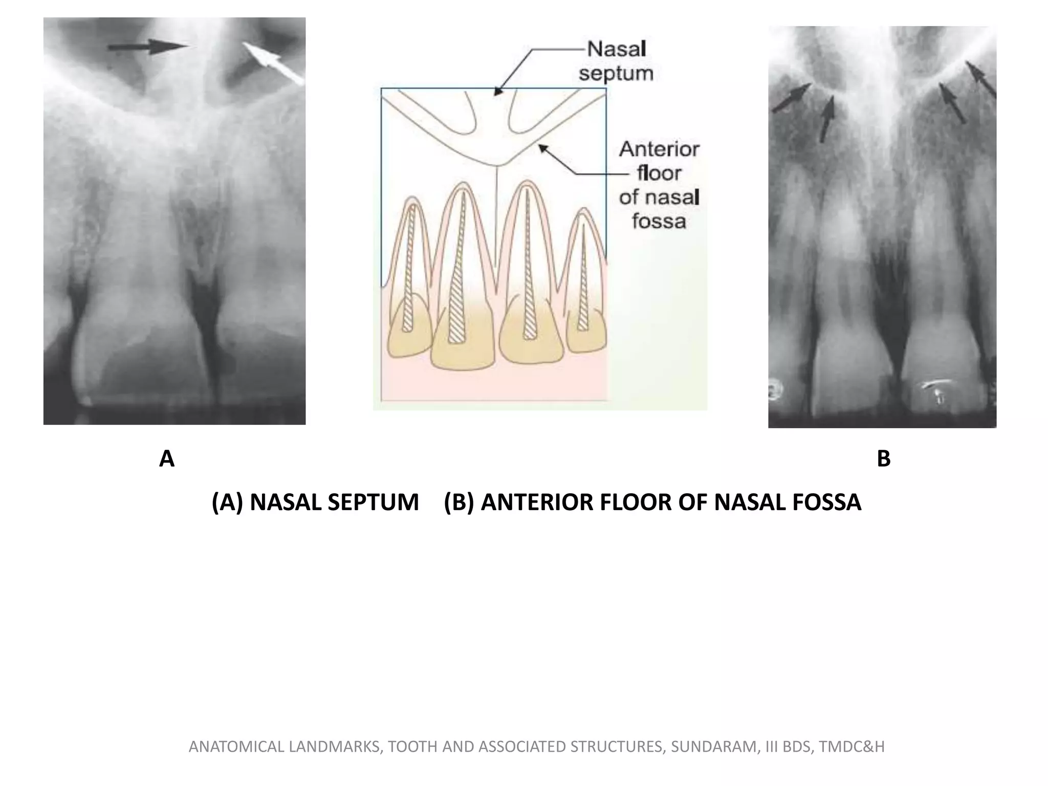 Anatomic landmarks seen in a IOPA | PPTX