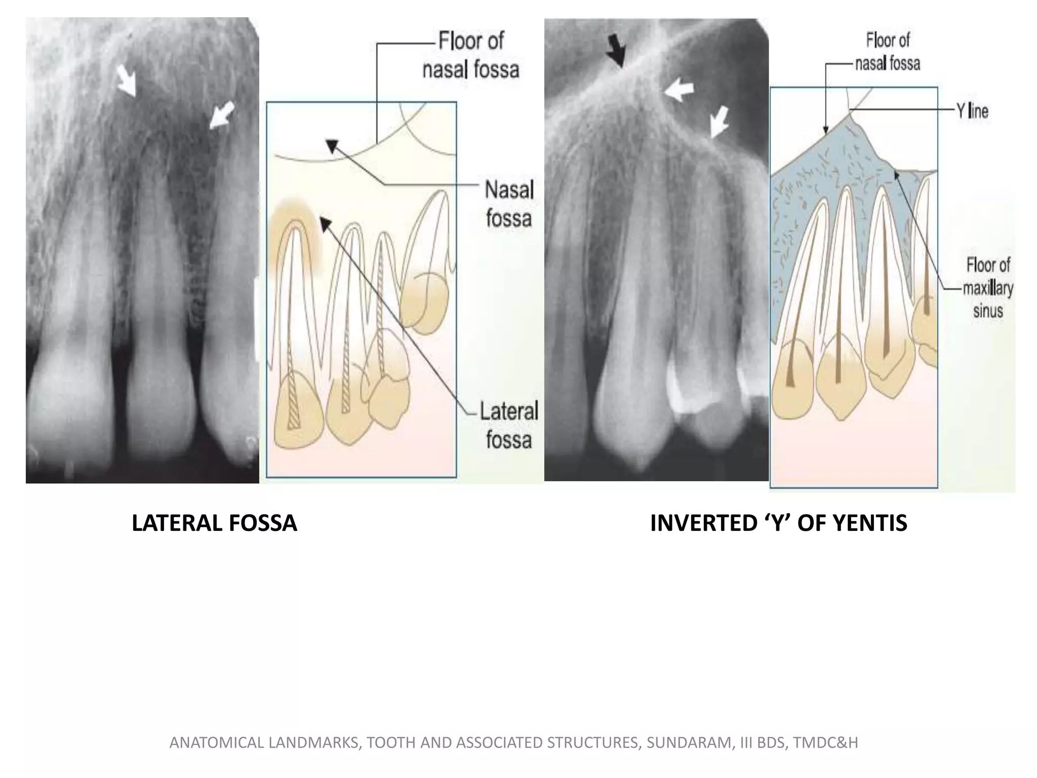 Anatomic landmarks seen in a IOPA | PPTX