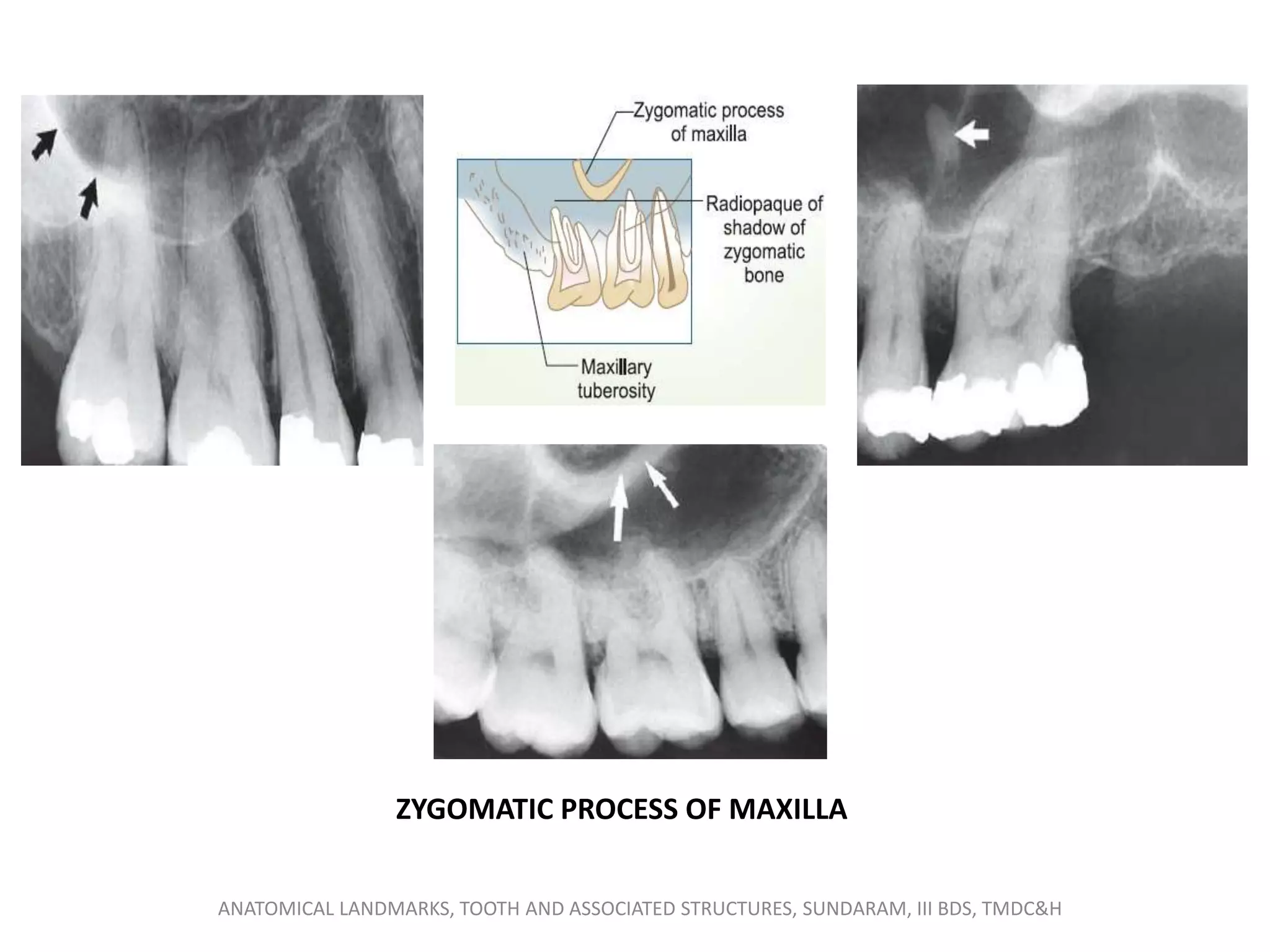 Anatomic landmarks seen in a IOPA | PPTX
