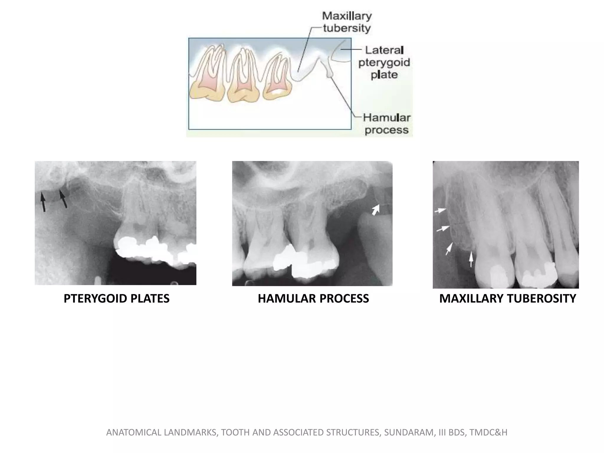 Anatomic landmarks seen in a IOPA | PPTX